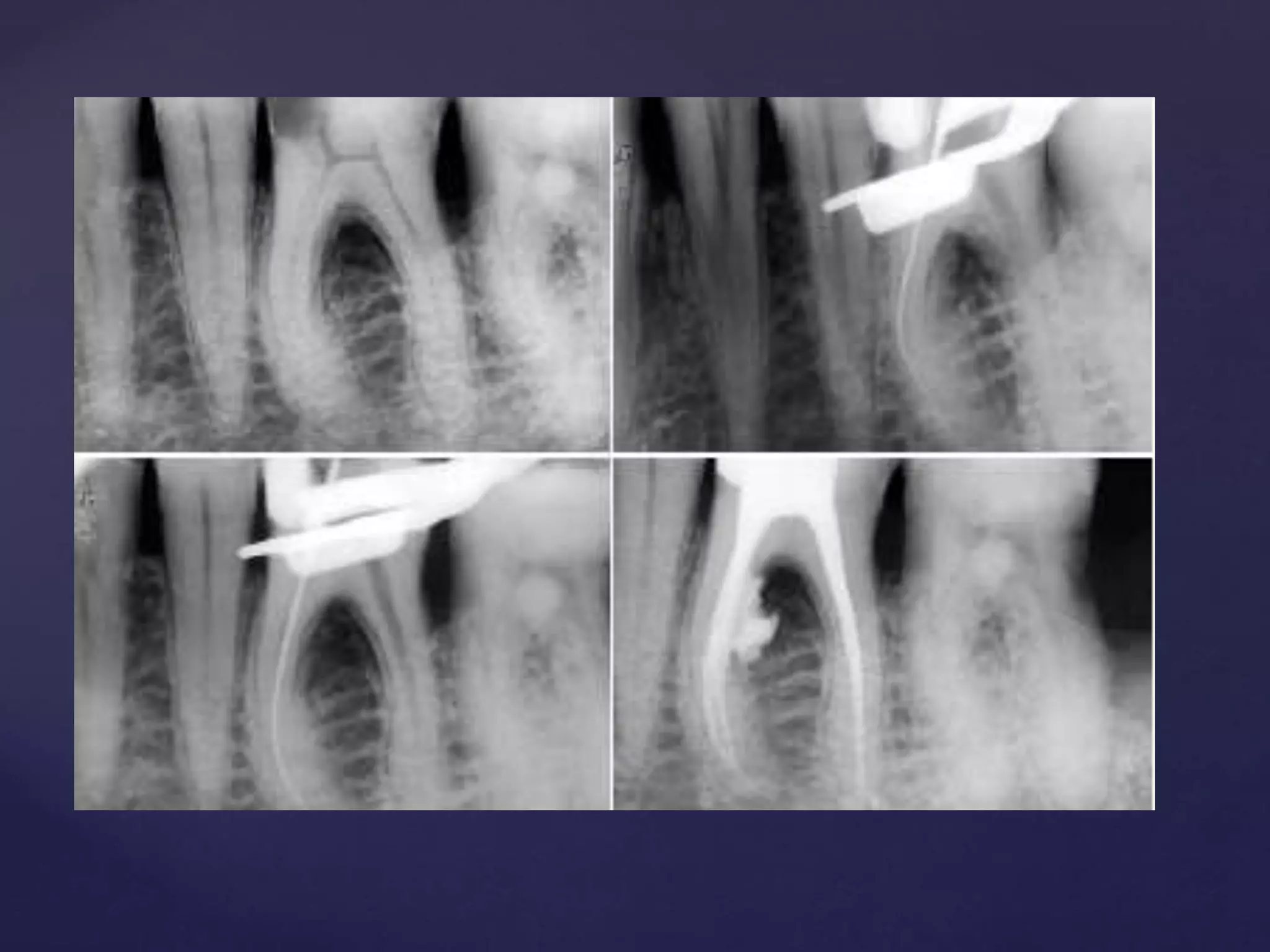Curved & dilacerated canals | PPTX