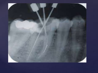 Curved & dilacerated canals | PPTX