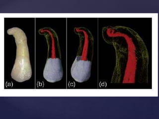 Curved & dilacerated canals | PPTX