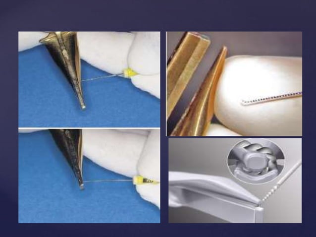 Curved & dilacerated canals | PPTX | Dental Health | Diseases and ...