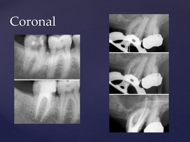 Curved & dilacerated canals | PPTX | Dental Health | Diseases and ...
