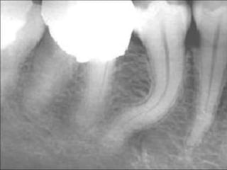 Curved & dilacerated canals | PPTX