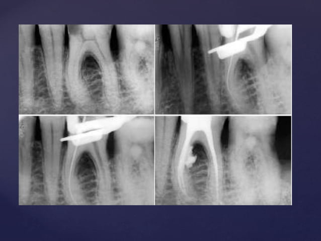 Curved & dilacerated canals | PPTX | Dental Health | Diseases and ...