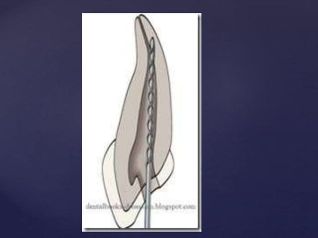 Curved & dilacerated canals | PPTX | Dental Health | Diseases and ...