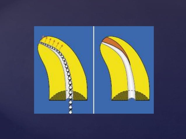 Curved & dilacerated canals | PPTX | Dental Health | Diseases and ...