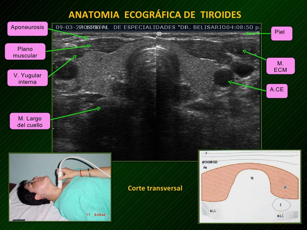 Ultrasonido De La Tiroides Que Es Ecografia Tiroides Tuydc