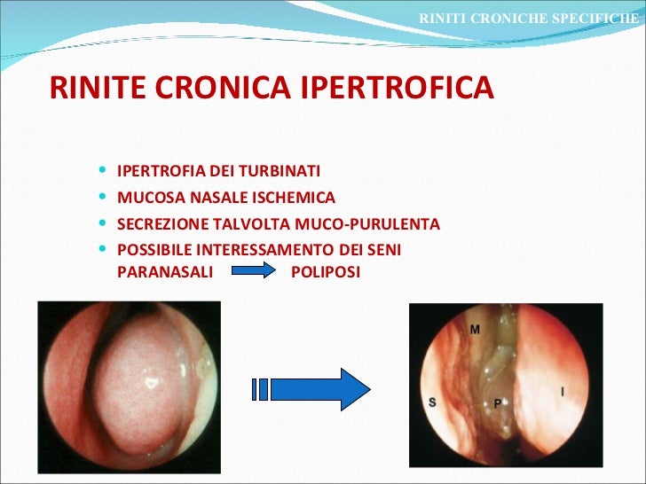 Riniti croniche