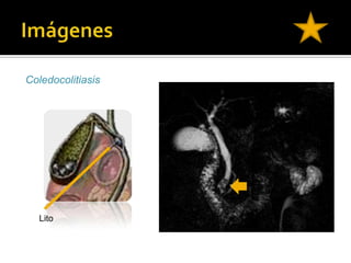 Colangiografia por Resonancia Magnetica | PPSX