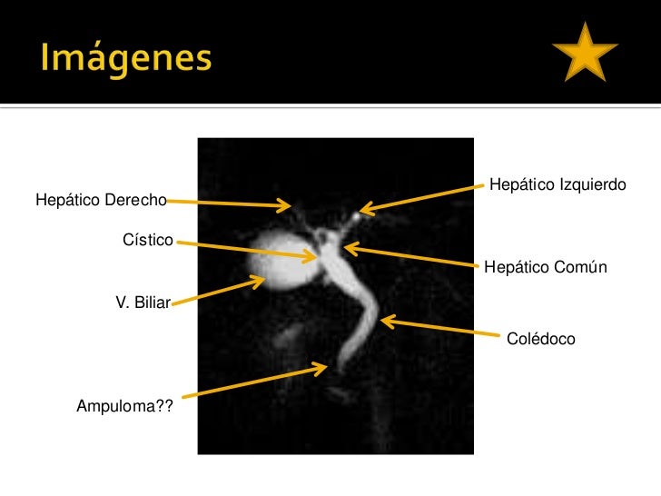 Colangiografia por Resonancia Magnetica
