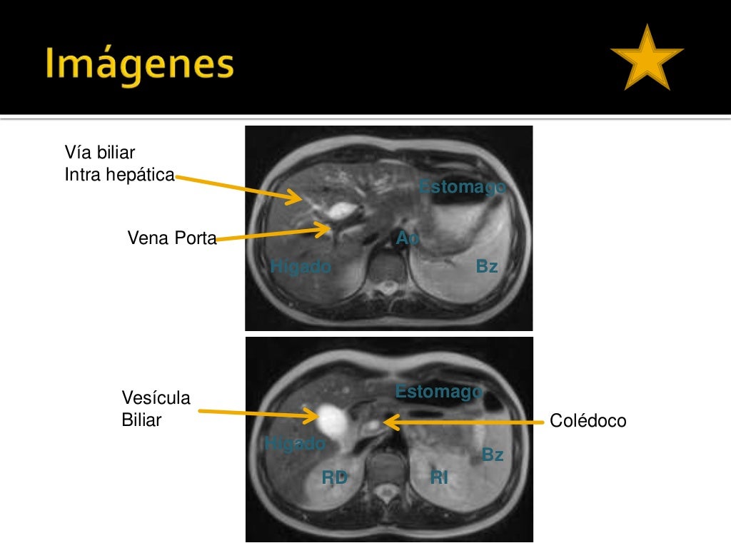 Colangio Ressonância Das Vias Biliares - RETOEDU