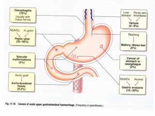 acute gastrointestinal bleeding /hematemesis/melena | PPT