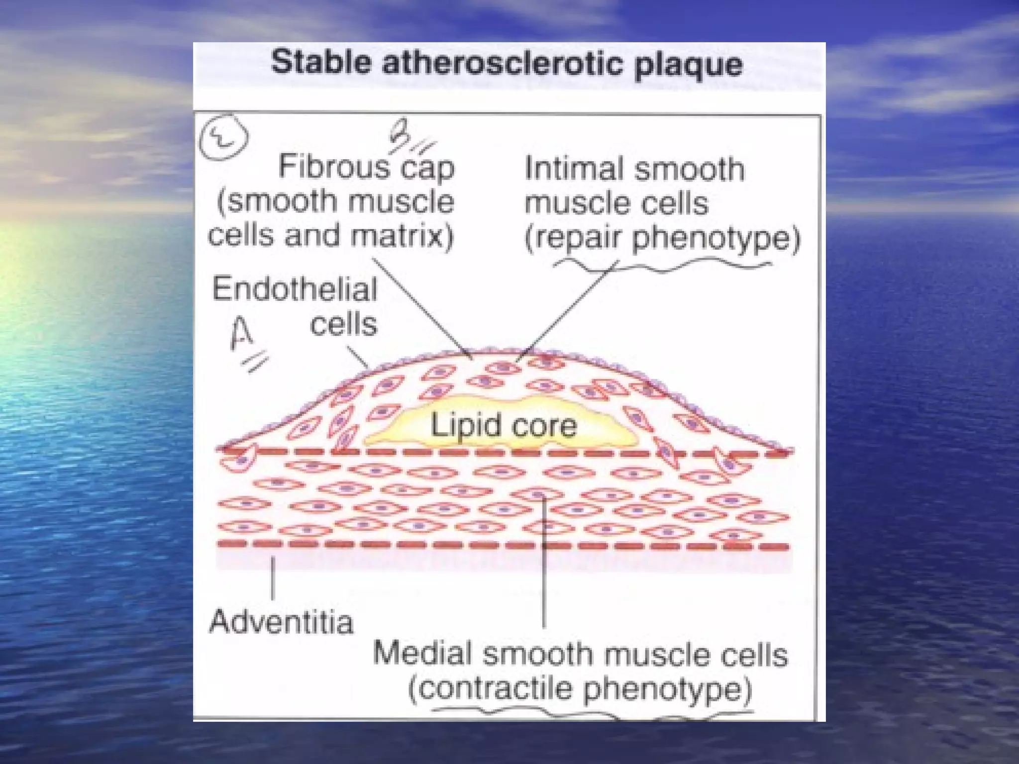ACUTE MYOCARDIA INFARCTION ISCHEMIA MI Draz MY | PPT | Heart and ...