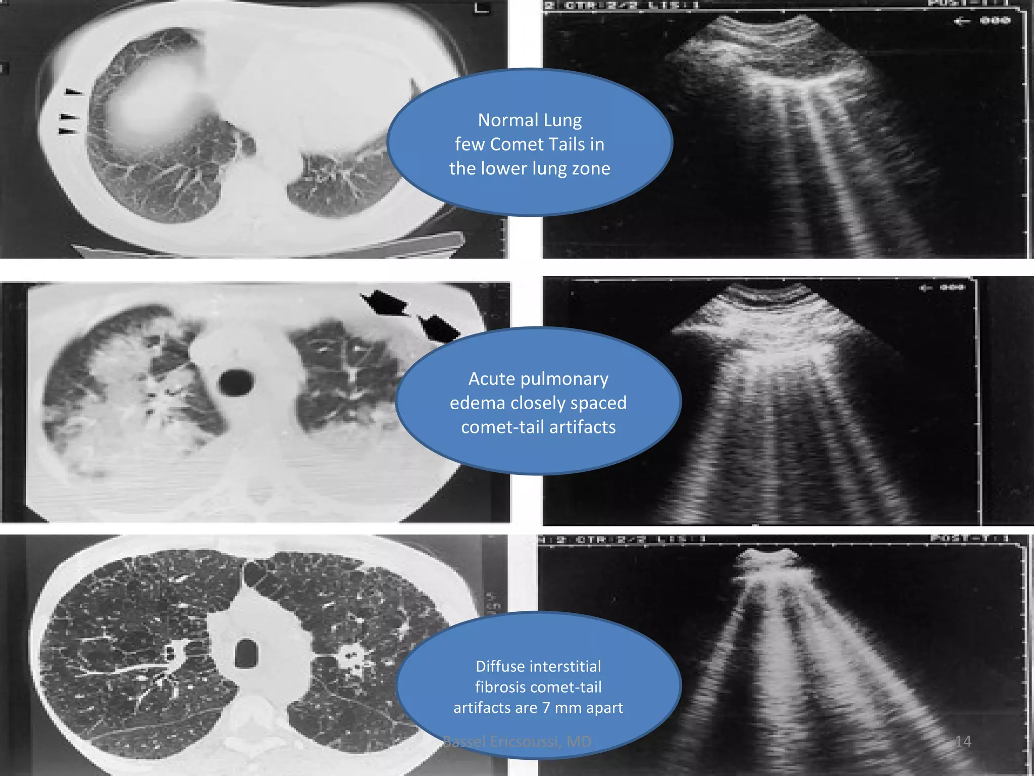 Ultrasonography Fundamentals In Critical Care: Lung Ultrasound, Pleural ...