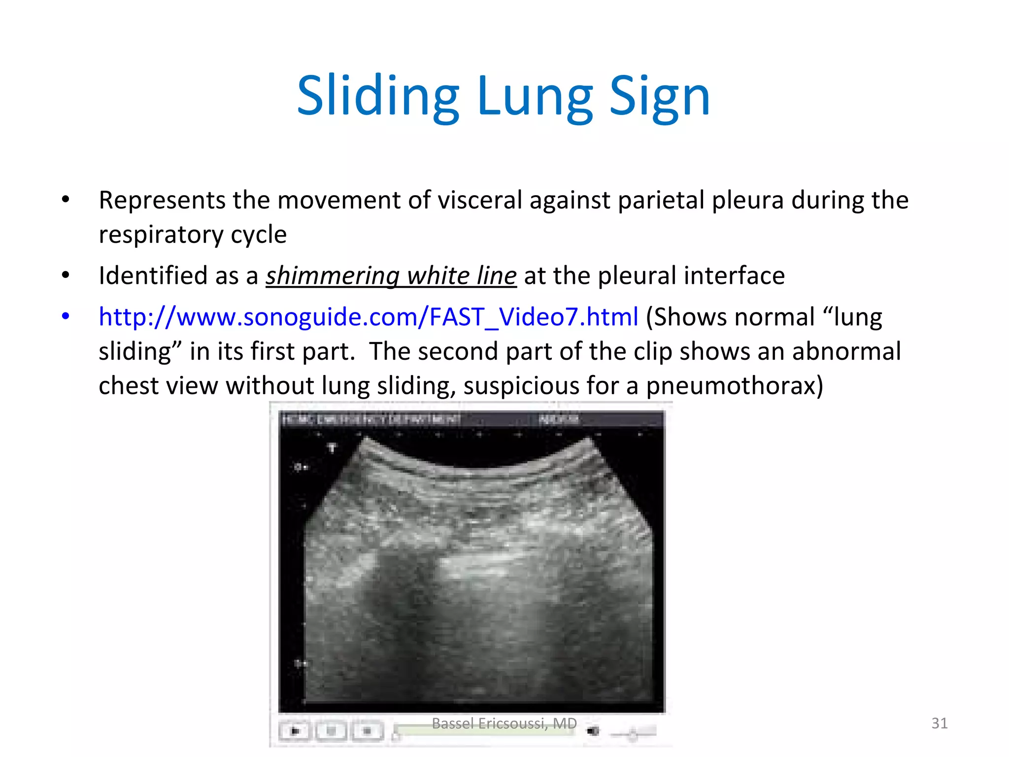 Ultrasonography Fundamentals In Critical Care: Lung Ultrasound, Pleural ...