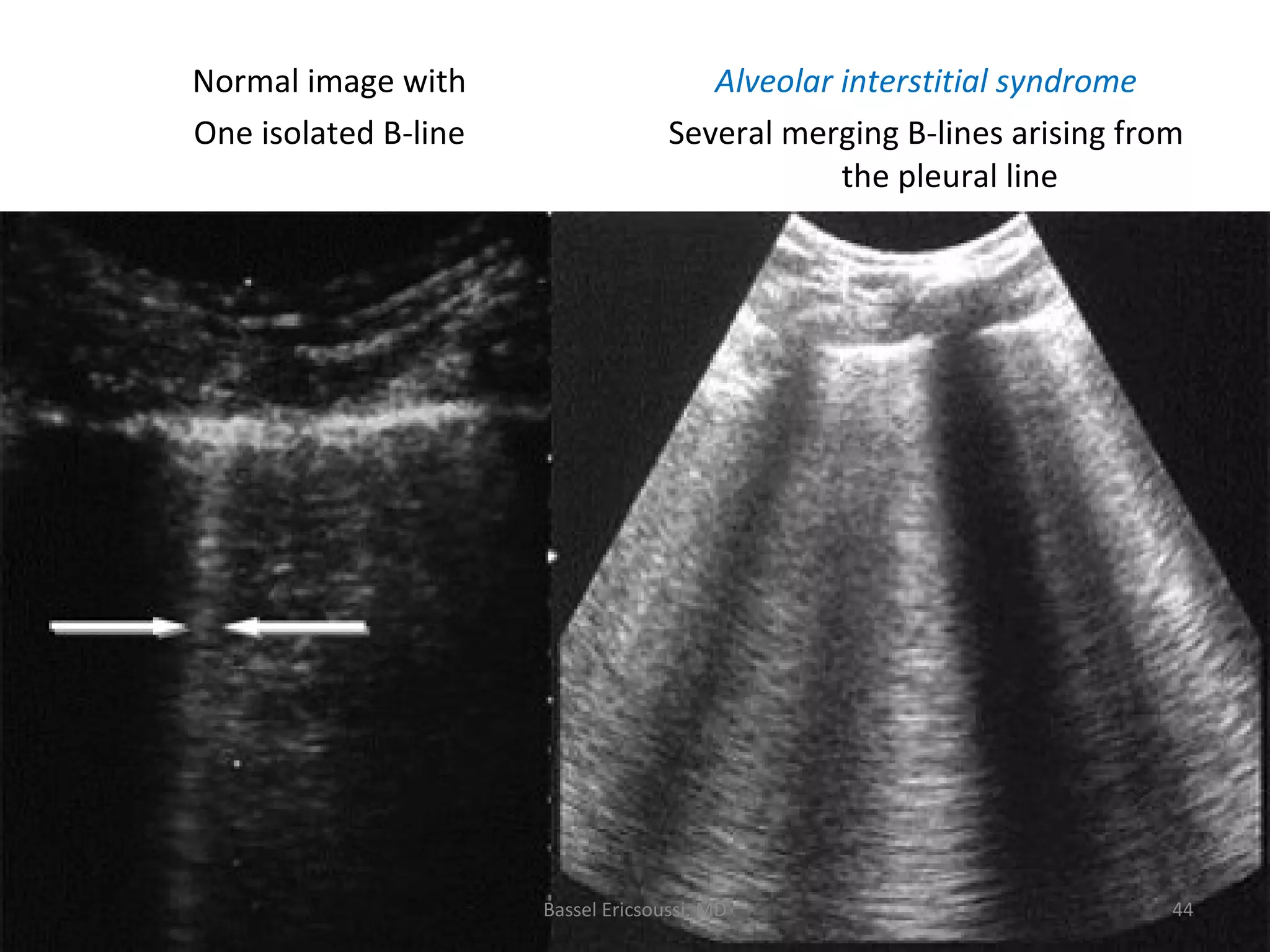 Ultrasonography Fundamentals In Critical Care: Lung Ultrasound, Pleural ...