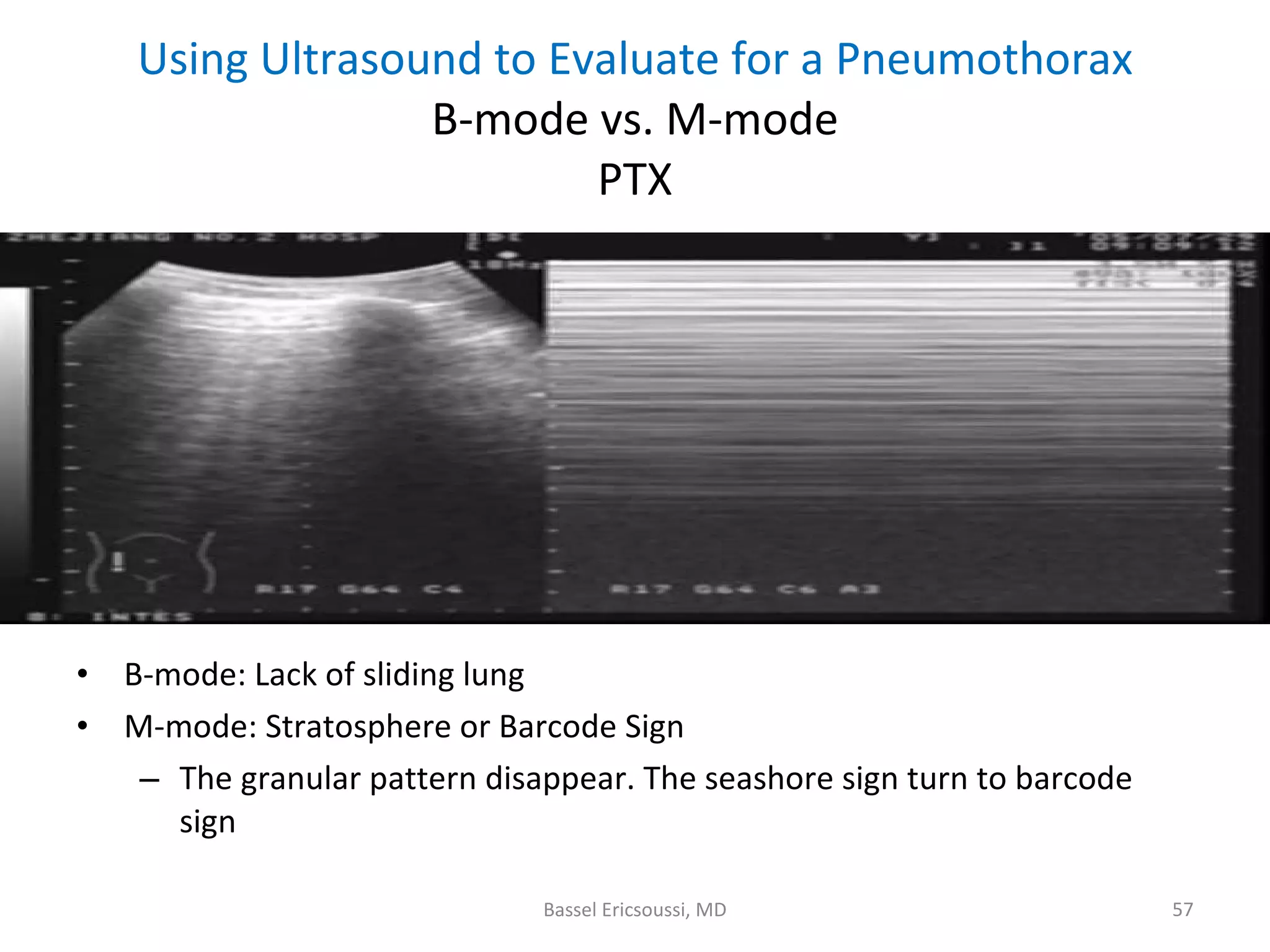 Ultrasonography Fundamentals In Critical Care: Lung Ultrasound, Pleural ...