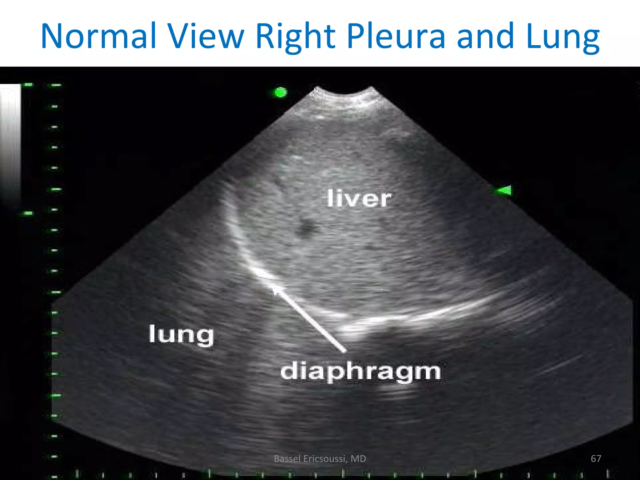 Ultrasonography Fundamentals In Critical Care: Lung Ultrasound, Pleural ...