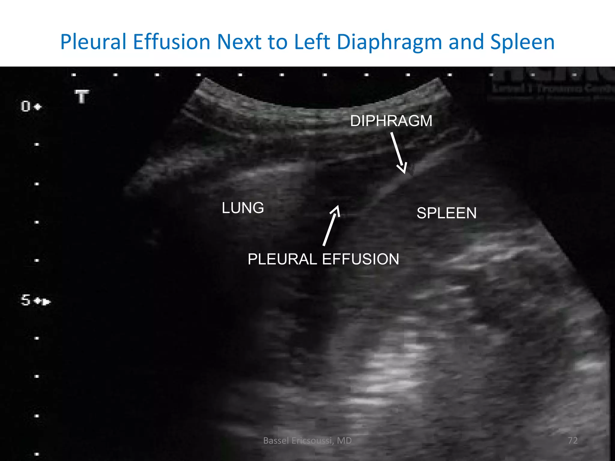 Ultrasonography Fundamentals In Critical Care: Lung Ultrasound, Pleural ...
