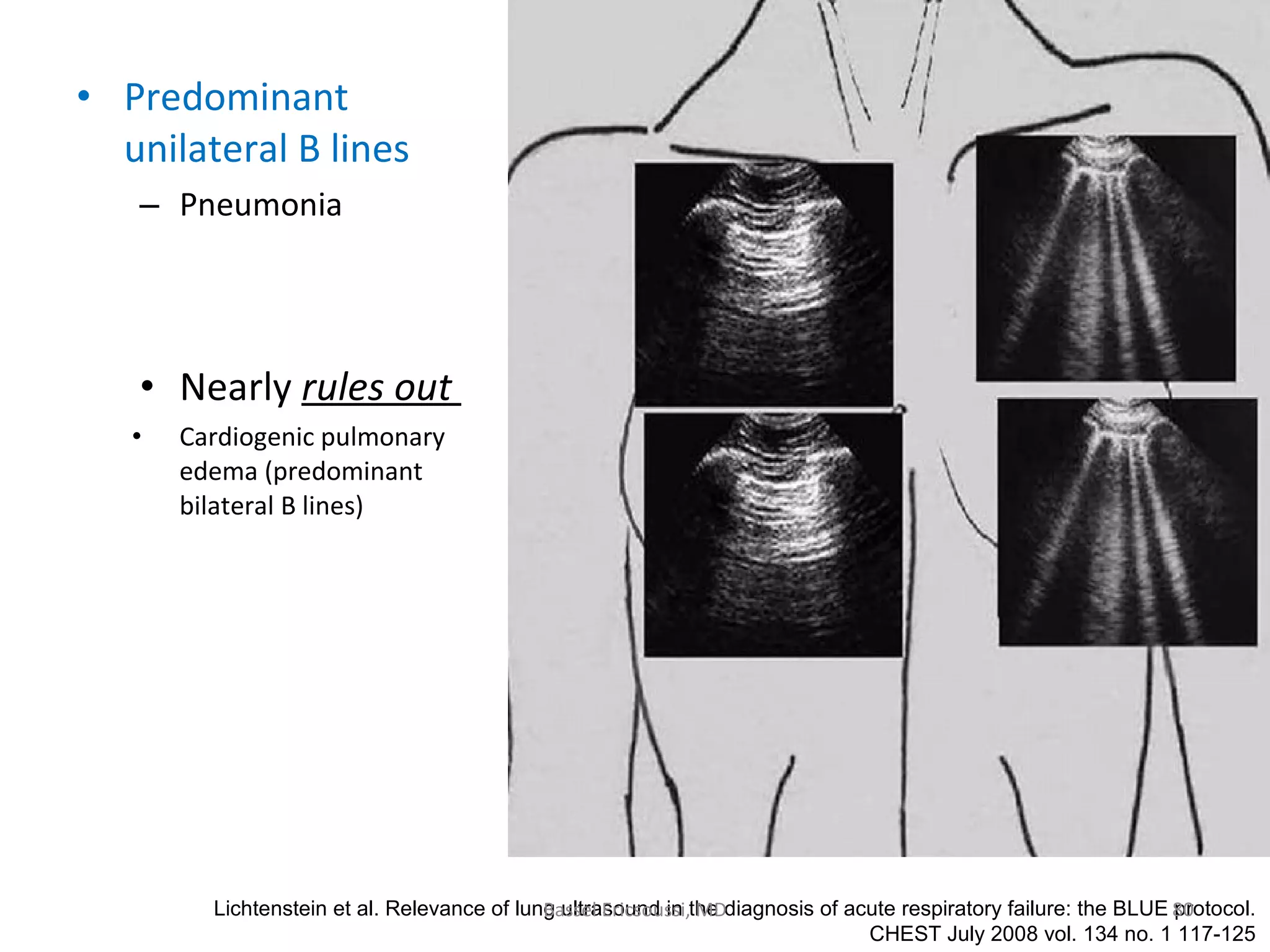 Ultrasonography Fundamentals In Critical Care: Lung Ultrasound, Pleural ...