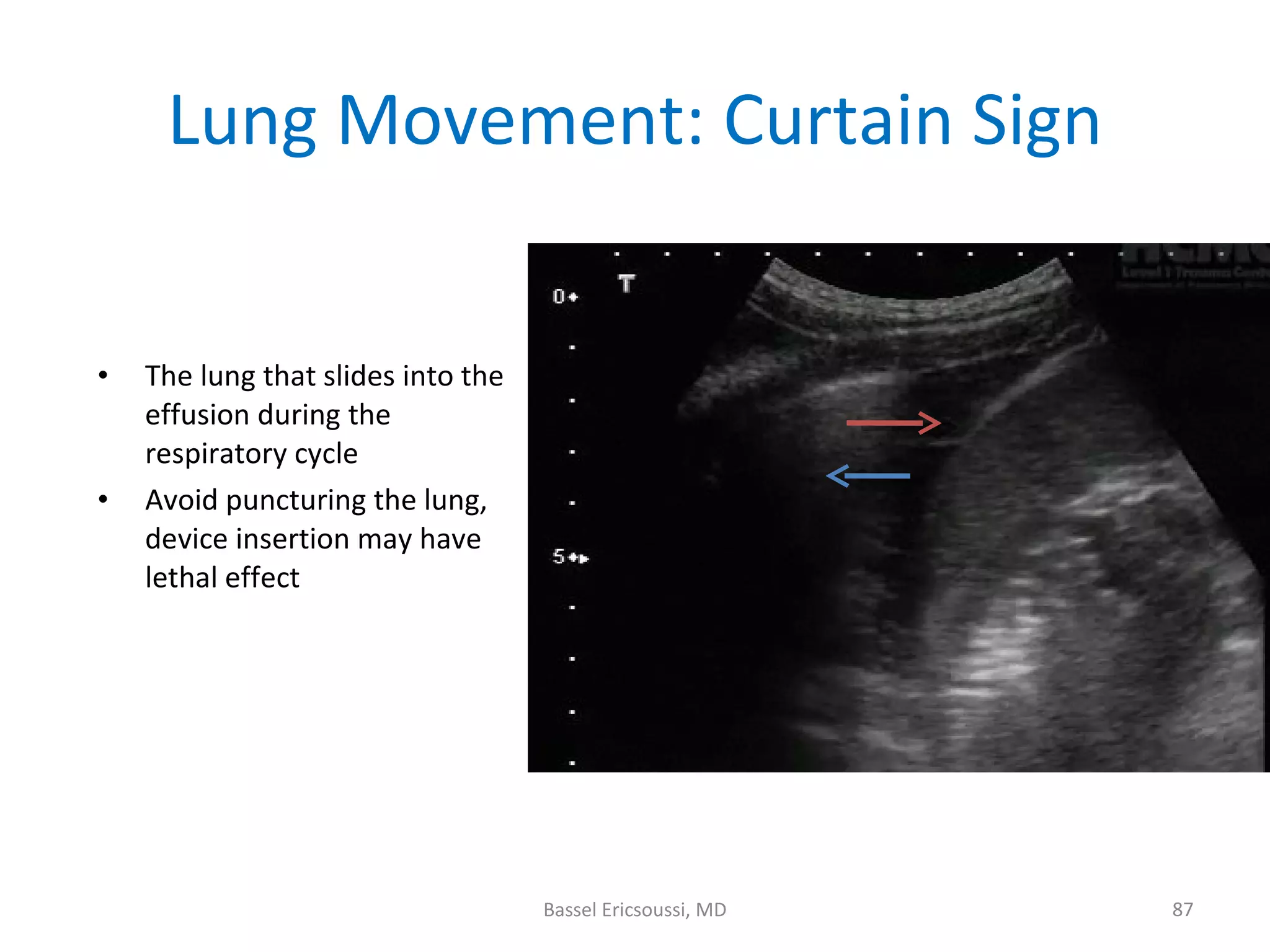 Ultrasonography Fundamentals In Critical Care: Lung Ultrasound, Pleural ...