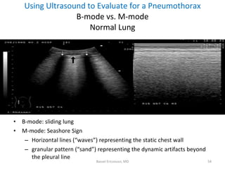 Ultrasonography Fundamentals In Critical Care: Lung Ultrasound, Pleural ...