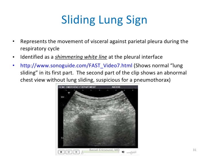 Ultrasonography Fundamentals In Critical Care: Lung Ultrasound, Pleur…