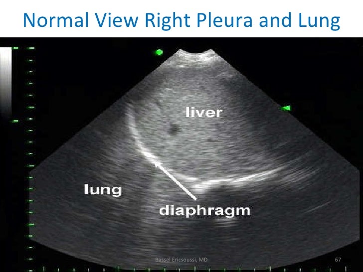 Ultrasonography Fundamentals In Critical Care: Lung Ultrasound, Pleur…
