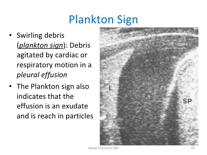 Ultrasonography Fundamentals In Critical Care: Lung Ultrasound, Pleur…