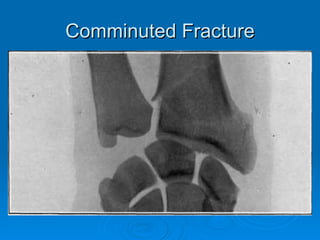 FRACTURES | PPT
