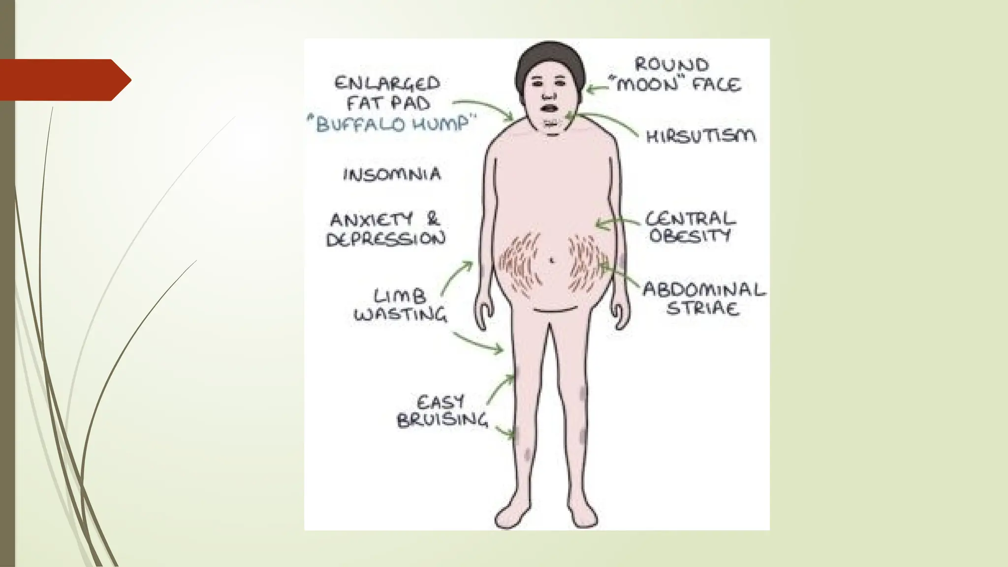 cushimg syndrome, pathophysiology clinical manifestations pptx | PPTX
