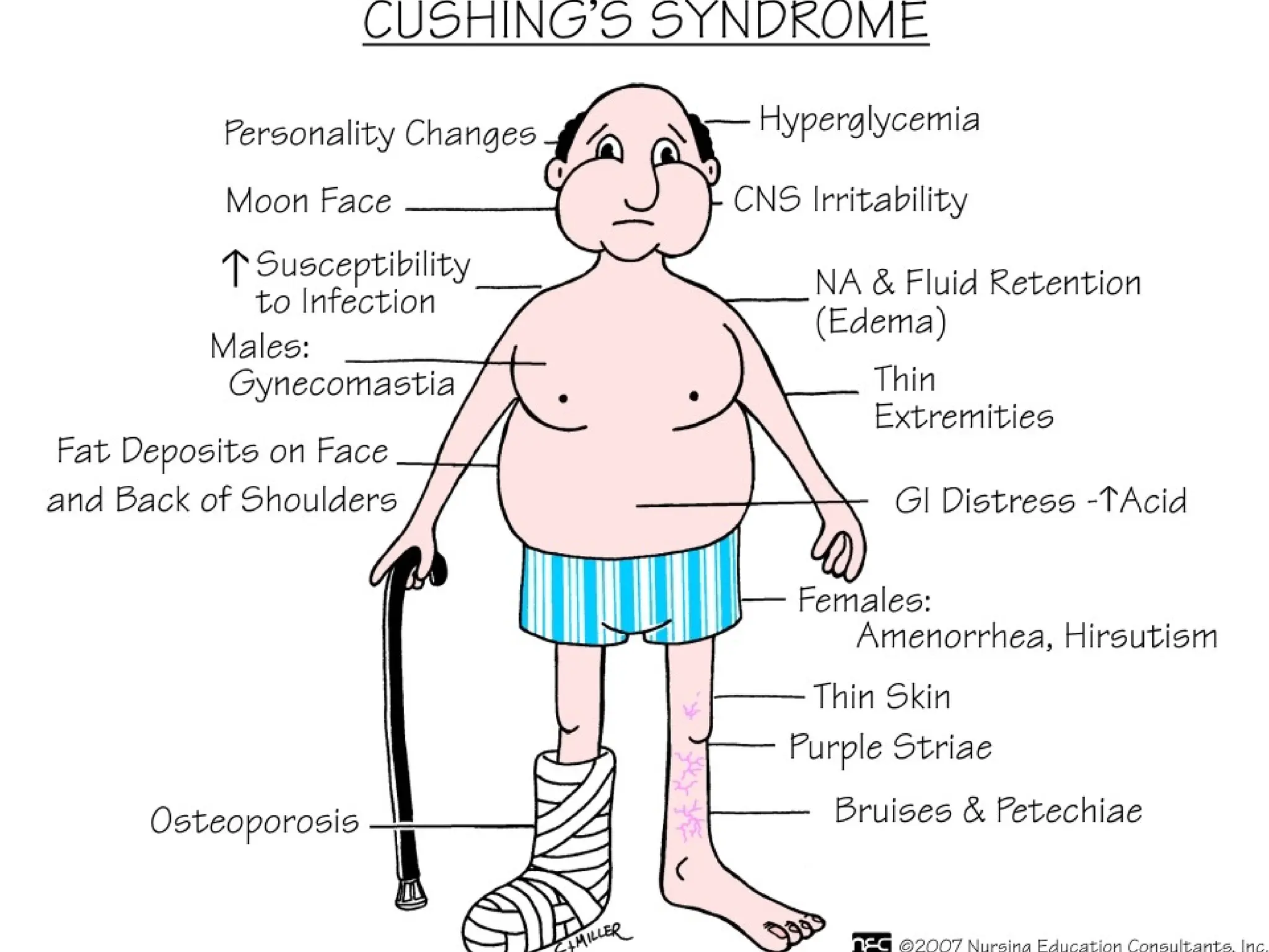 Cushings syndrome - endocrinology ppt... | PPTX