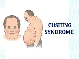 Cushings syndrome - endocrinology ppt... | PPTX