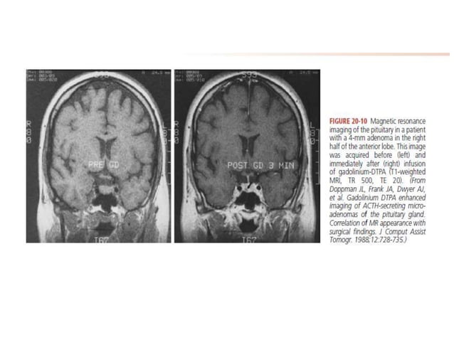 CUSHING’S DISEASE-DIAGNOSIS AND MANAGEMENT.pptx