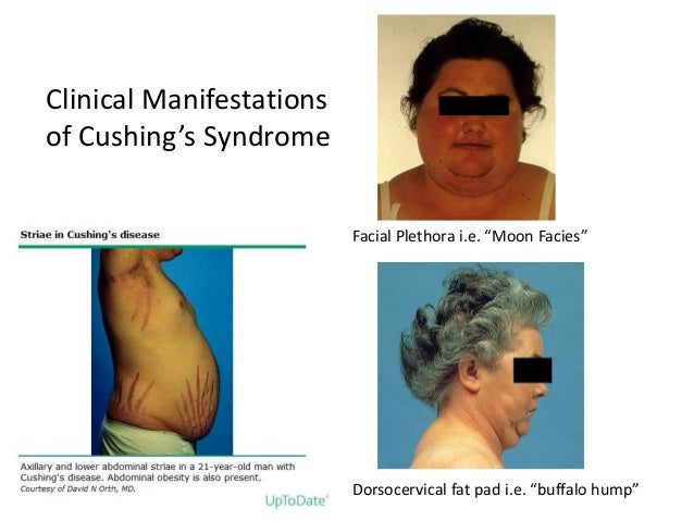 Pediatric Cushings Syndrome