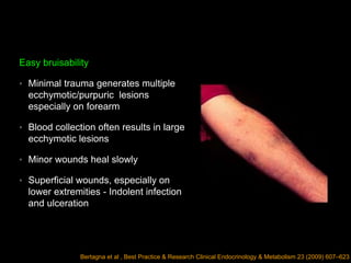Cushing's syndrome | PPTX
