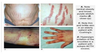 Approach to Cushing Syndrome | PPT