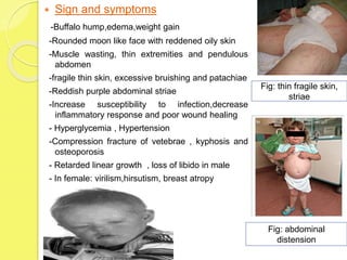 Cushing syndrome | PPTX
