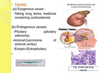 Cushing syndrome | PPTX