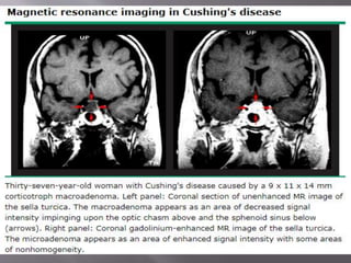 Cushing syndrome and addision disease | PPTX