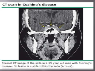Cushing syndrome and addision disease | PPTX