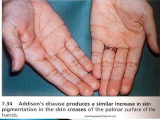 Addisons Disease Skin Pigmentation Pictures