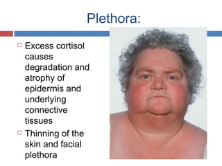 Cushing's Syndrome by Dr. Aryan | PPT