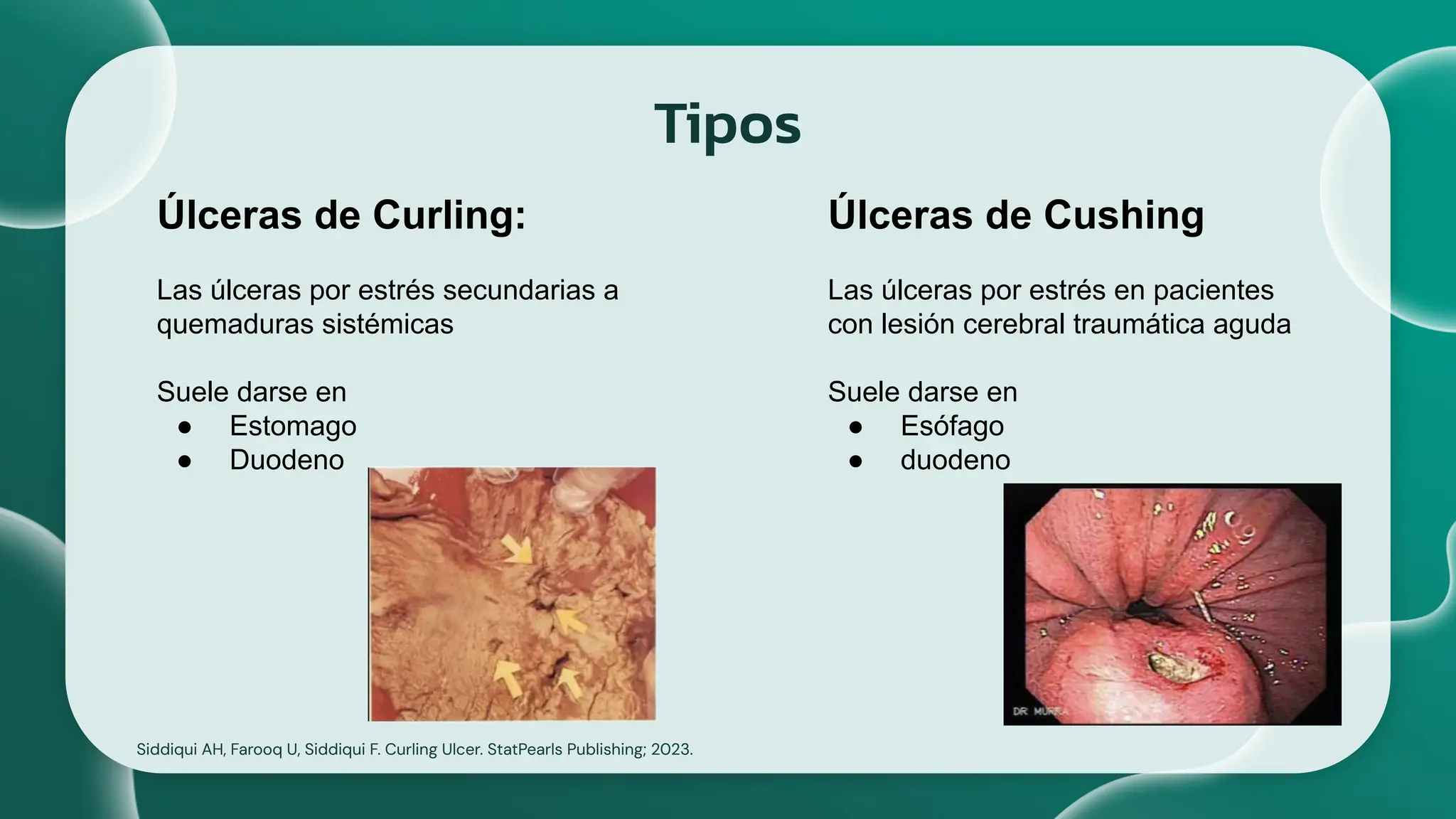 Ulcera de cushing y curling | PDF