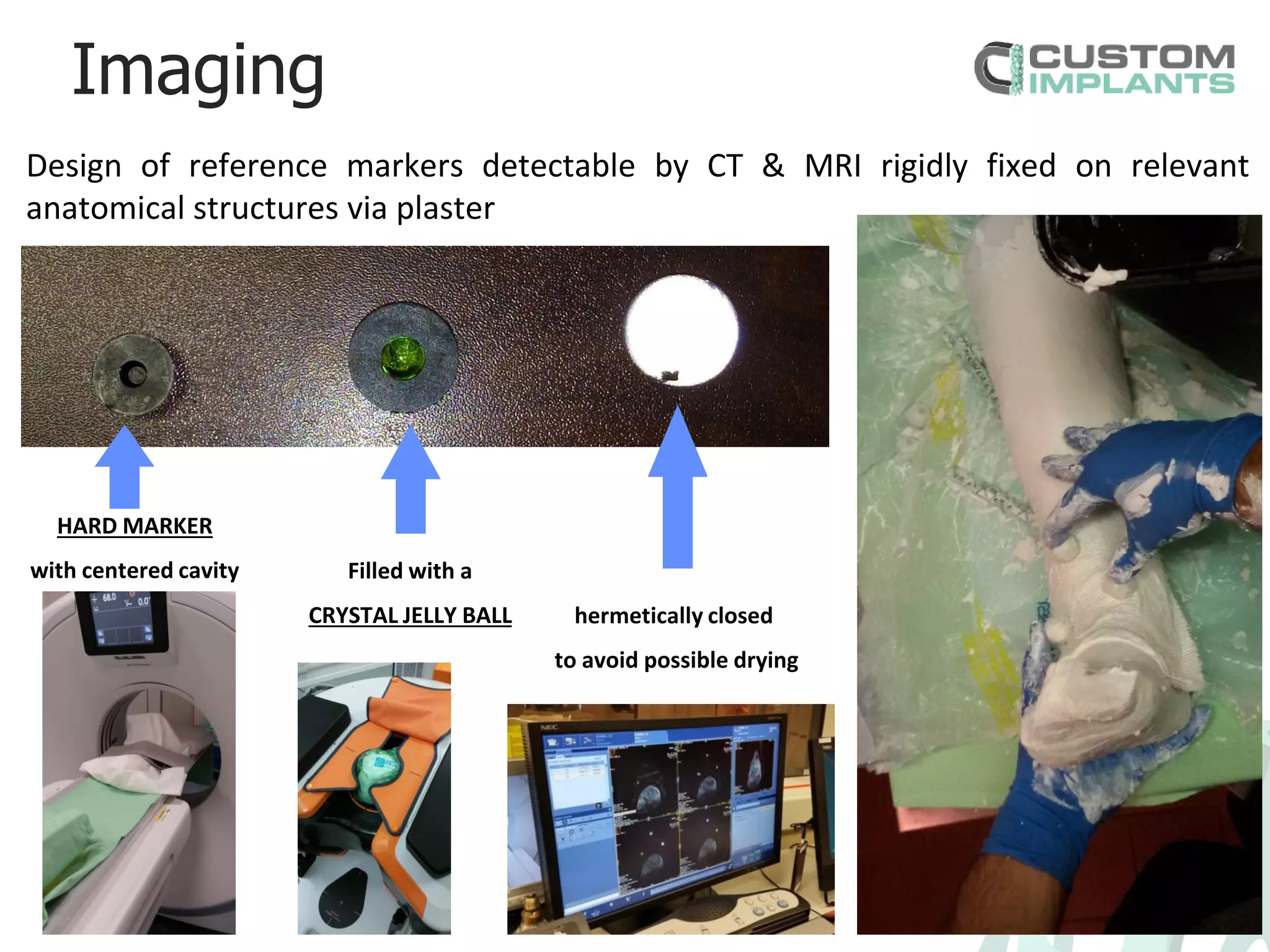 Custom endoprotesi - Design of patient specific ankle prosthesis for ...