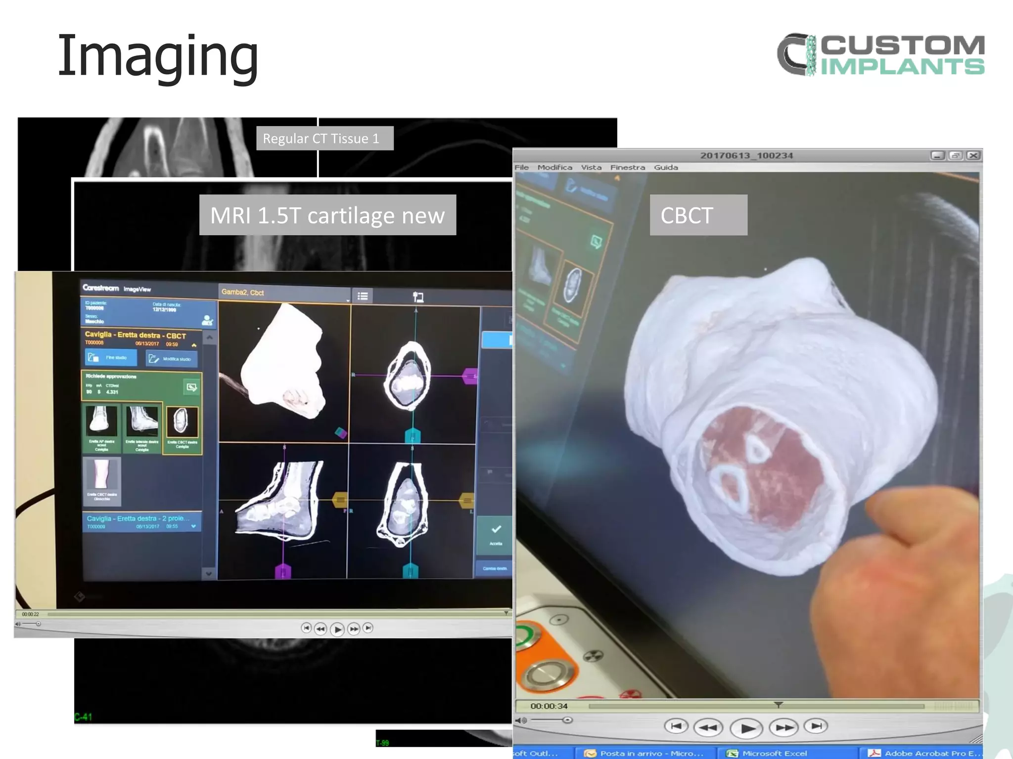 Custom endoprotesi - Design of patient specific ankle prosthesis for ...