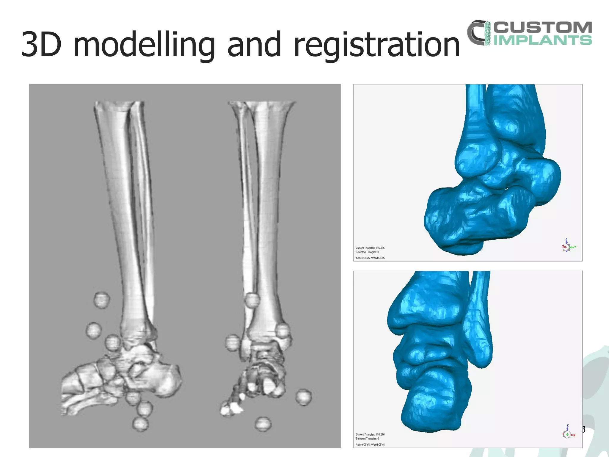 Custom endoprotesi - Design of patient specific ankle prosthesis for ...