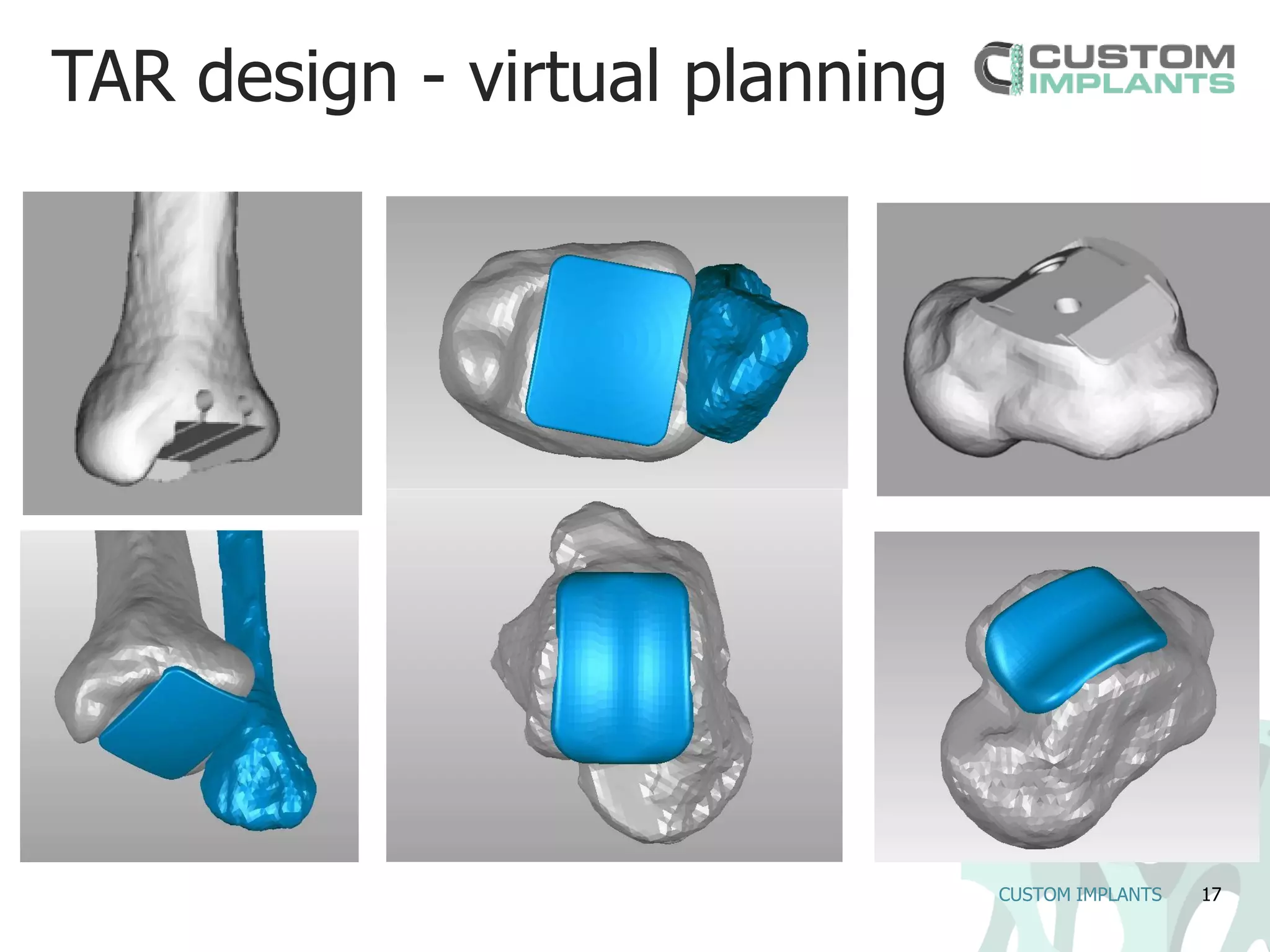 Custom endoprotesi - Design of patient specific ankle prosthesis for ...