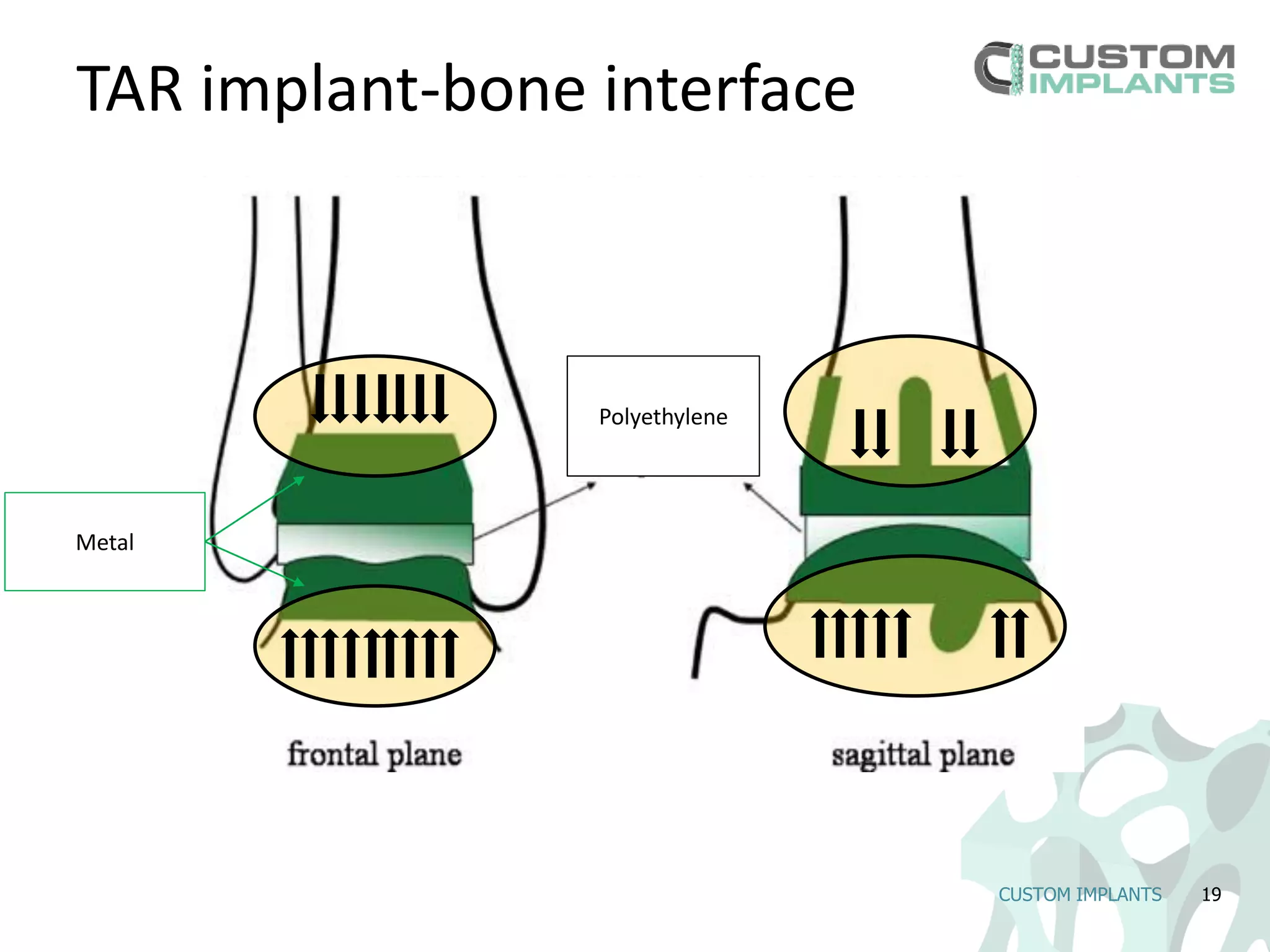 Custom endoprotesi - Design of patient specific ankle prosthesis for ...