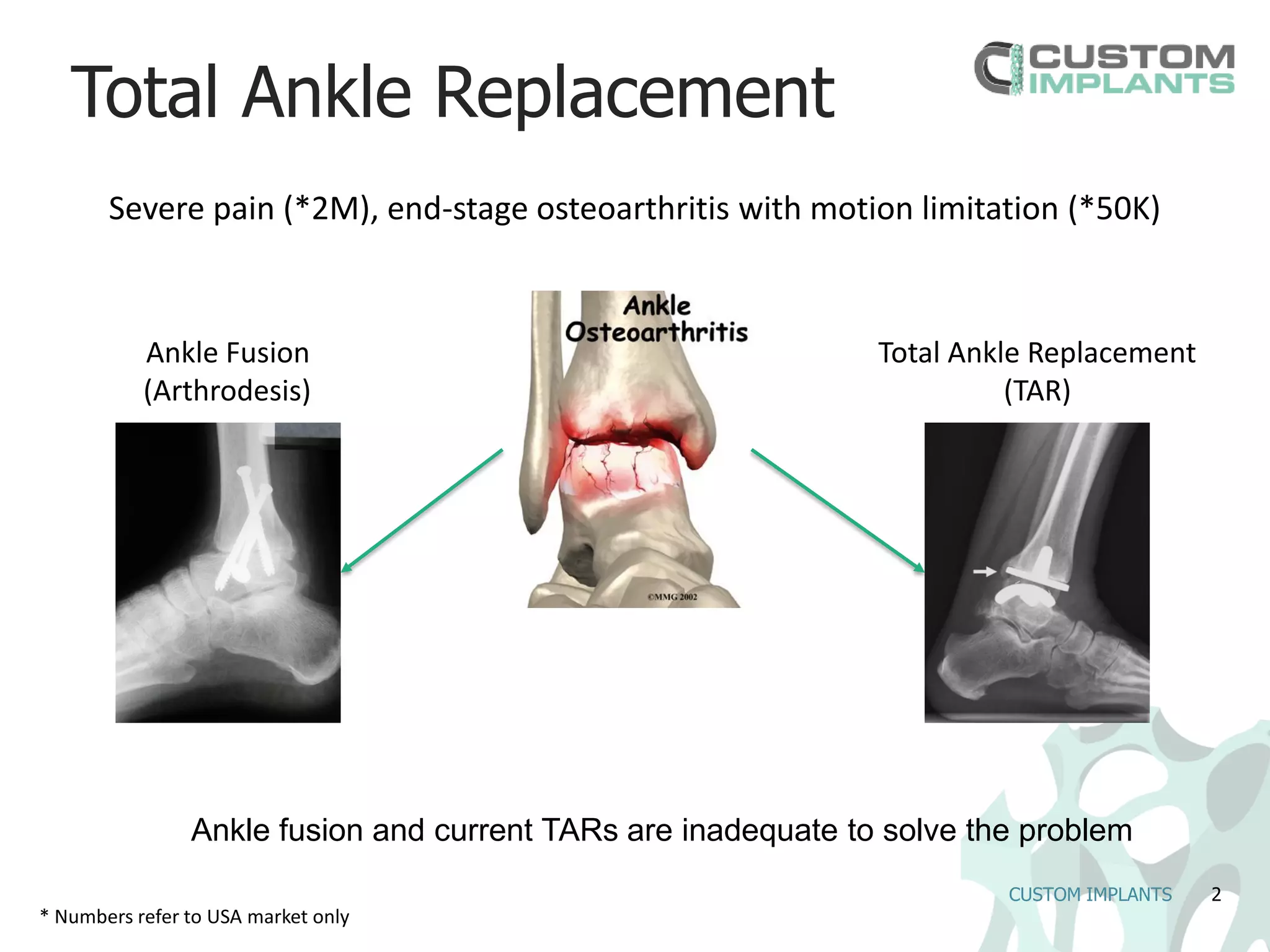 Custom endoprotesi - Design of patient specific ankle prosthesis for ...
