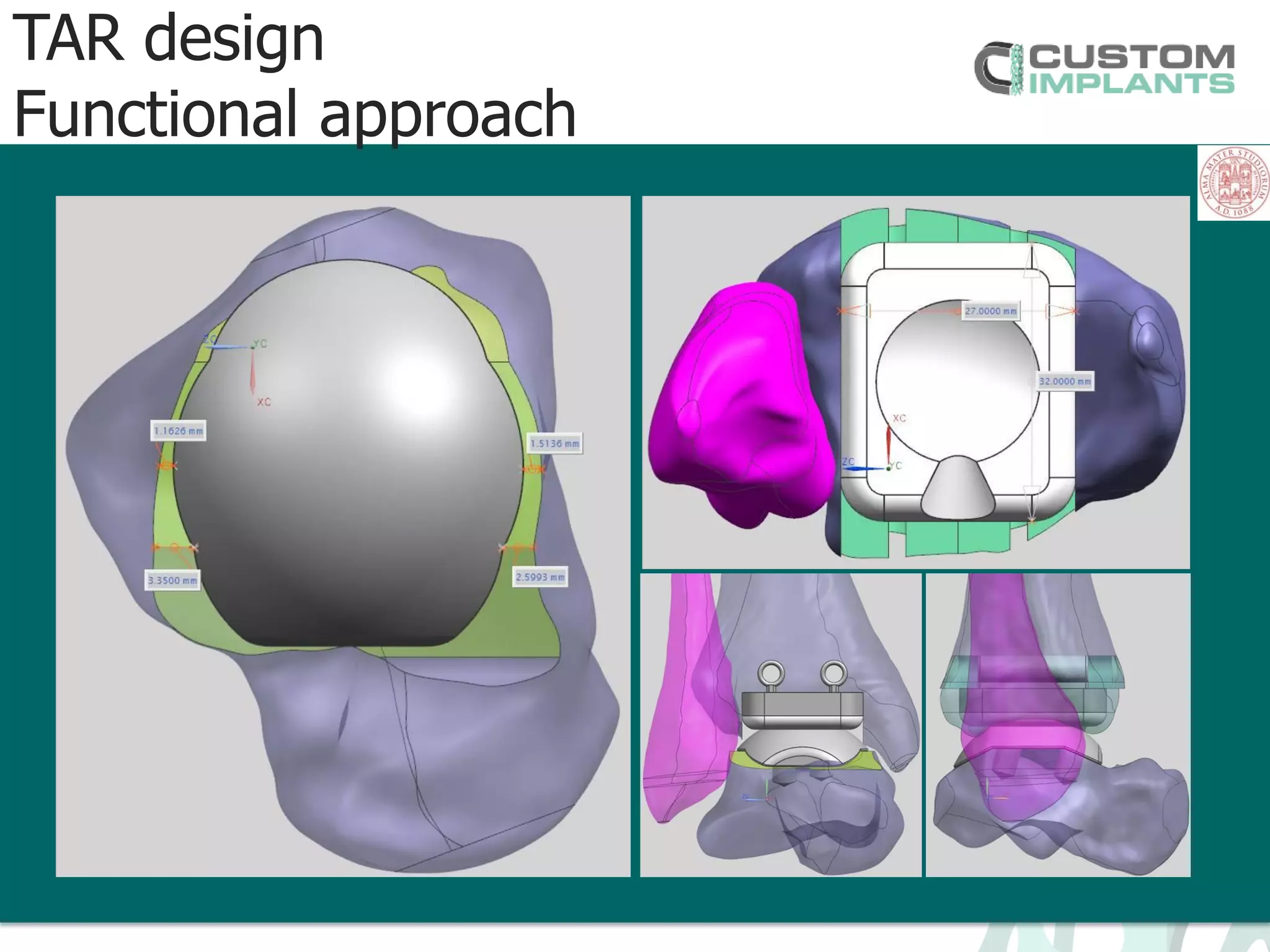 Custom endoprotesi - Design of patient specific ankle prosthesis for ...